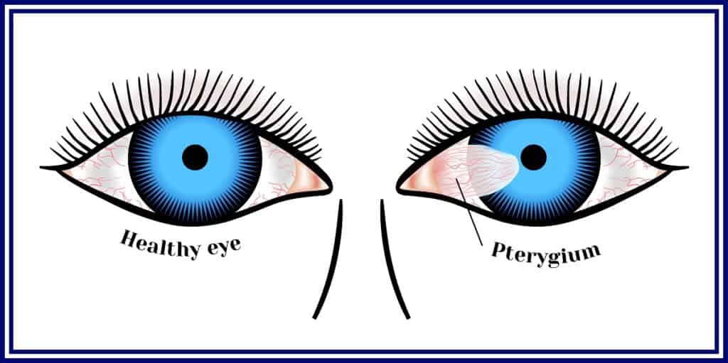 Pterygium Archives - mlv