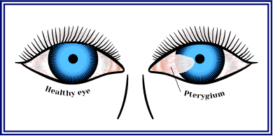 Pterygium Treatment Miami - Surfer’s Eye Care Fort Lauderdale